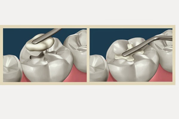 Fillings for baby teeth - How to treat cavities in baby teeth - Small ...