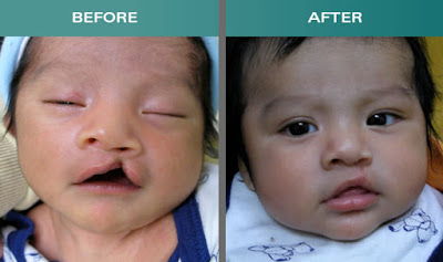 Cleft Lip and Cleft Palate in Children : All you need to know | Small Bites